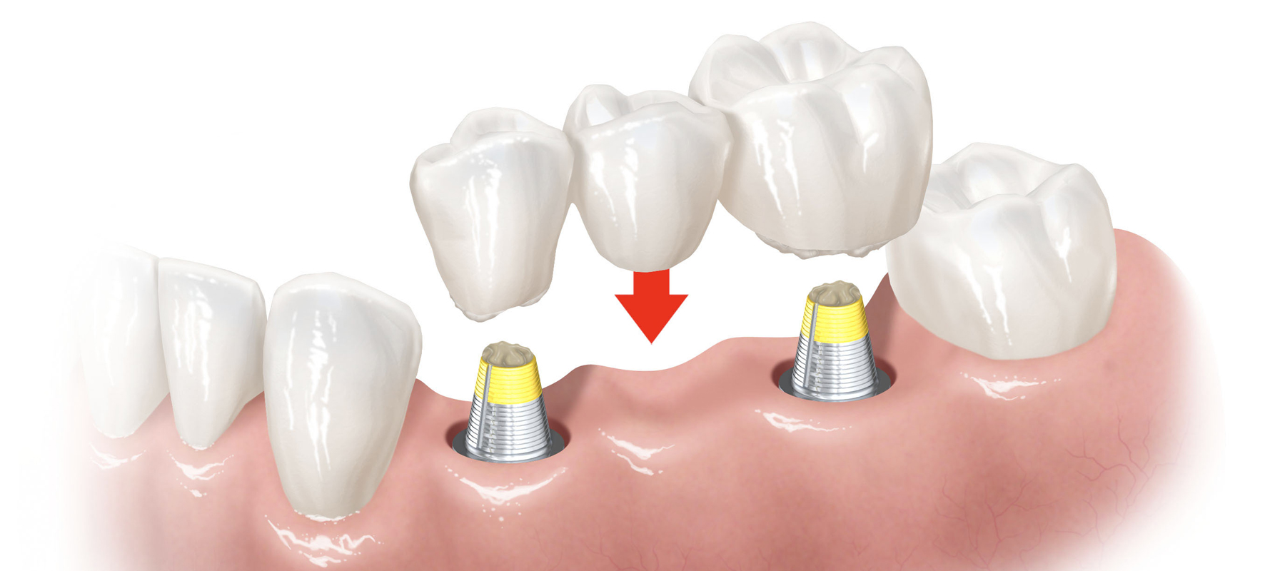 Implant retained bridges and dentures | Arnica Dental Care