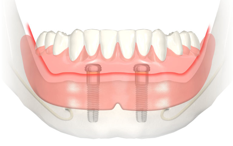 Implant retained bridges and dentures | Arnica Dental Care